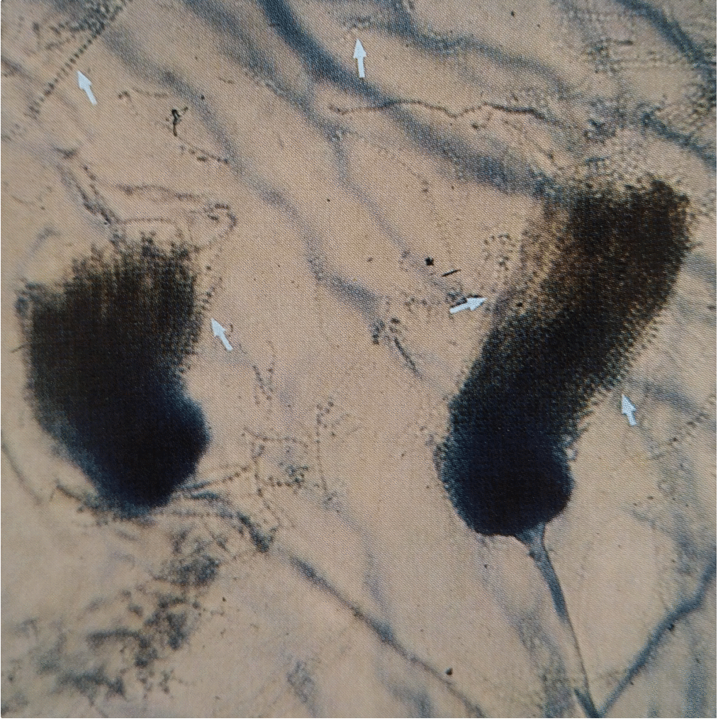 Invasive Aspergillose - Aspergillose Pilzinfektion